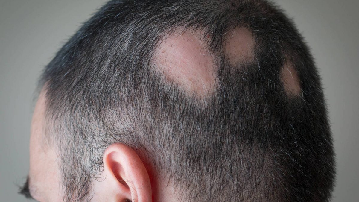 Enfermedades detrás de la pérdida de cabello.